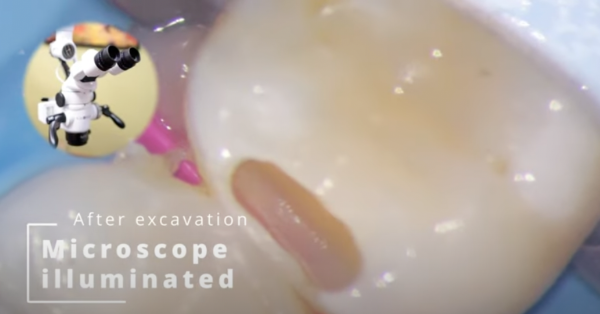 Exploring the Details: What Can 19x Magnification See on a Dental Microscope?